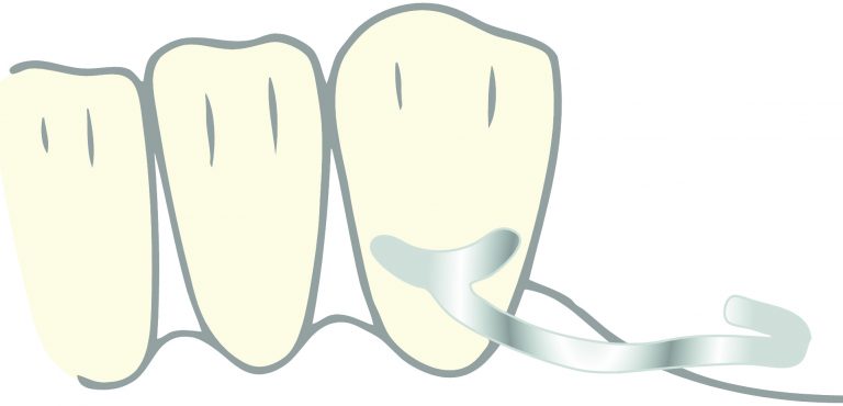 J-Clasp — Eurodontic