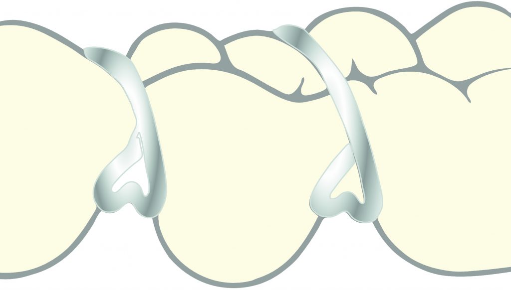 Triangle Clasp — Eurodontic