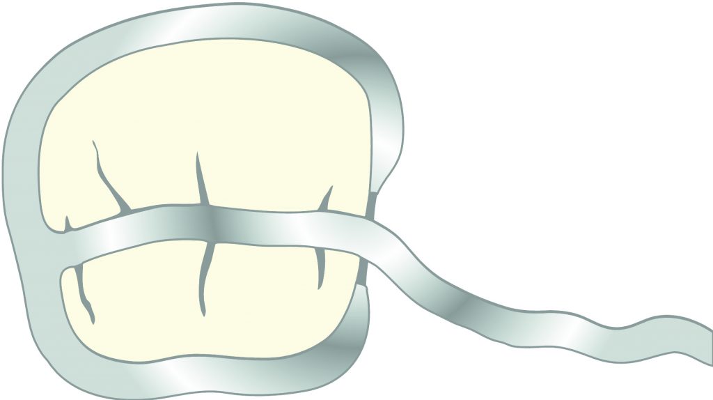 T-Clasp — Eurodontic